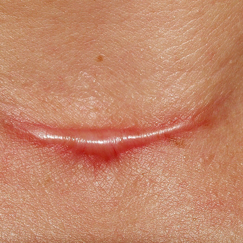 Hypertrophic scar, what is it? – Mediluxe Health Solutions